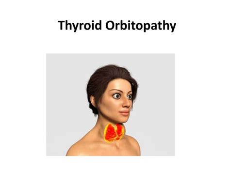 Thyroid Associated Orbitopathy Of Dr Sohel Mahmud Pptx