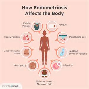 Endometriosis Signs And Symptoms What To Look For