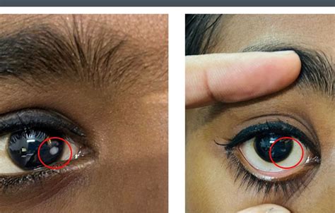 Ayurvedas Treatment For Corneal Opacity Dr Shan Aboo Hussain Posted On The Topic Linkedin
