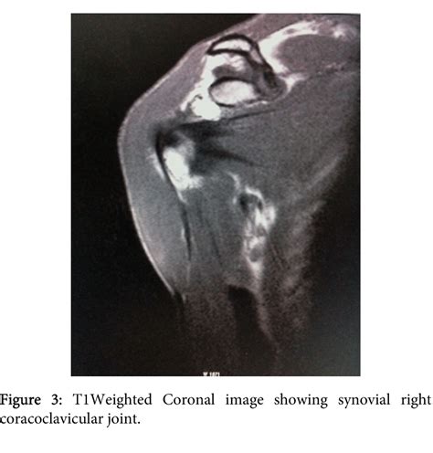 Coracoclavicular Joint A Rare Entity