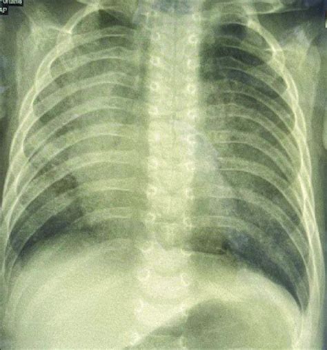 Chest X Ray Showing Diffuse Ground Glass Opacity With Perihilar Download Scientific Diagram