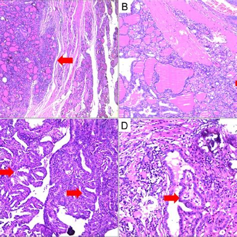 Pathological Findings Of Thyroid Composite Carcinoma A B Follicular Download Scientific