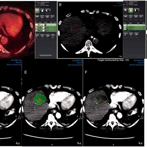 Measurement Of Ablation Margins In 3 D In A Patient With Colorectal Download Scientific Diagram