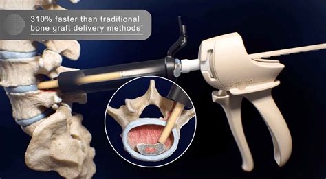 Depuy Synthes Vivigen Bone Graft Image