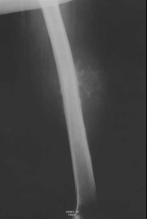Periosteal Osteosarcoma Femur X Rays Radiology Case Studies Ctisus