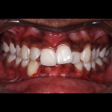 Frontal Ortho Ai Object Detection Dataset And Pre Trained Model By Mgr Cde Ai