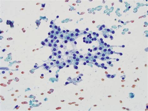 The Bethesda System For Reporting Thyroid Cytopathology Bsrtc Oncohema Key