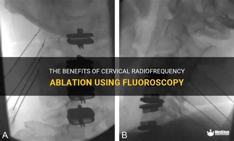 The Benefits Of Cervical Radiofrequency Ablation Using Fluoroscopy Medshun