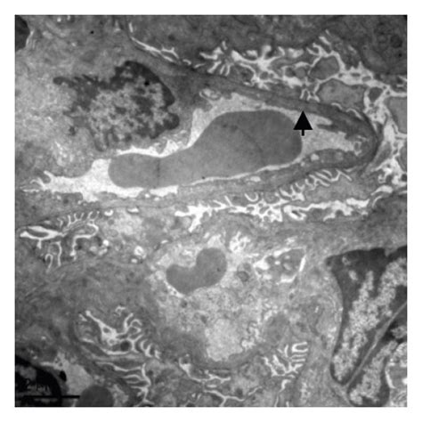 Normal Control Group A Basement Membrane Is Even And Clear Podocyte Download Scientific