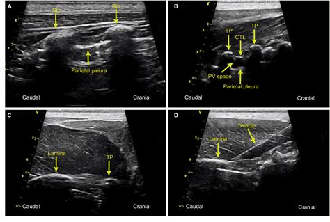 Figure 1 From The Ultrasound Guided Retrolaminar Block Volume Dependent Injectate Distribution
