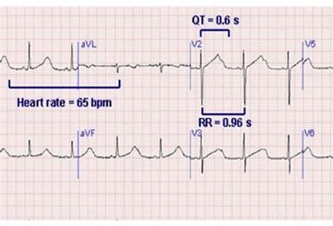Syncope In An 18 Year Old Woman Case Presentation