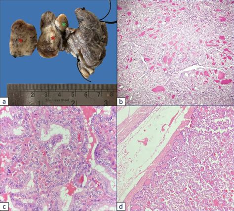 A Left Hemithyroidectomy With A Cut Surface Of The Pyramidal Lobe