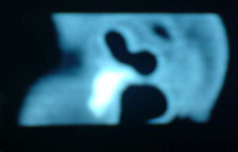 Preauricular Sinus Excision Using Operating Microscope Dr Paulose