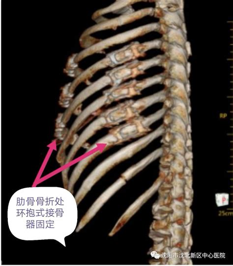 环抱式接骨器图片 环抱式接骨器图片 肋骨环抱器图片 第6页 大山谷图库