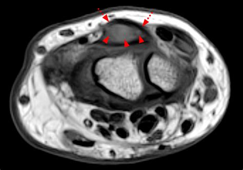 Stenosing Tenosynovitis Of The 4th Extensor Compartment Radsource