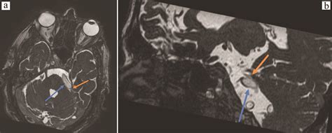 Benign Intracranial Hypertension