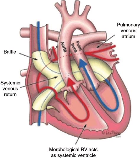 The Atrial Switch Procedure Senning Or Mustard An Intra Atrial