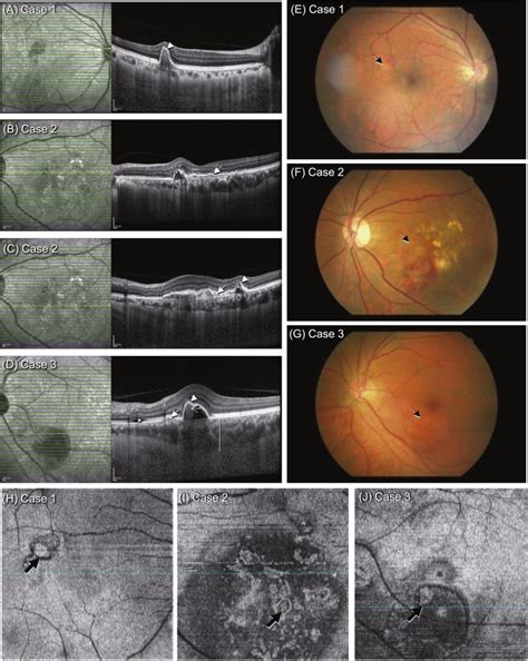 Prevalence Of Polypoidal Choroidal Vasculopathy Using Non Indocyanine