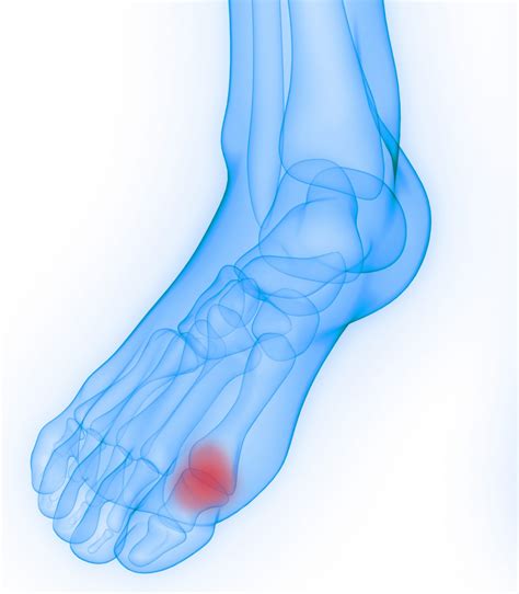 Hallux Rigidus Hallux Limitus Okaped