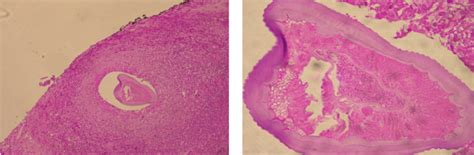 A Inflammatory Granuloma Composed Of A Polymorphous Infiltrate And A Inflammatory Granuloma Composed Of A Polymorphous Infiltrate And