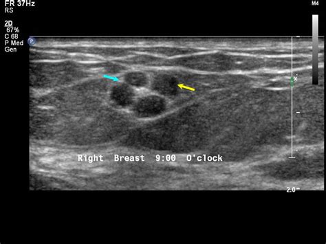 Atlas Of Breast Cancer Early Detection