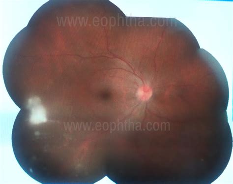 An Approach To A Case Of Retinitis