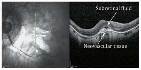 Choroidal Neovascularization Oct
