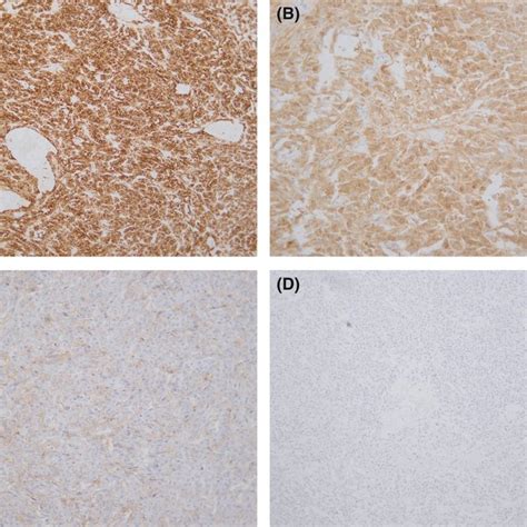 Immuno‐histochemical Slides Showing Strong And Diffuse Positive