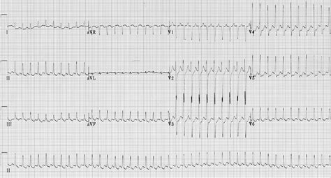 Atrial Flutter Springgerty