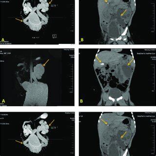Imaging Modalities And Results Illustrating A Dilated Left Ureter And Download Scientific
