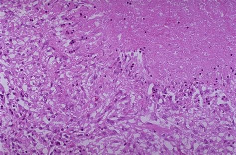 Caseous Necrosis In Tb