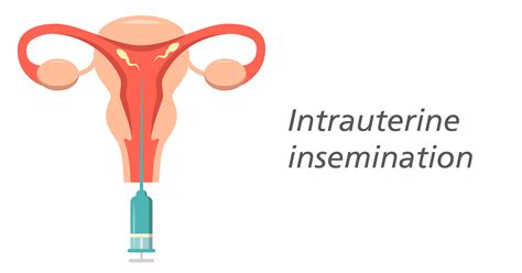 Fresh And Frozen Sperm For Iui And Ivf Cycles Esco Medical