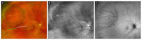 Ultra Widefield Imaging Identifies New Retinoschisis Findings