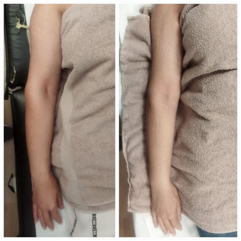 Мануален Лимфен Дренаж Пловдив Physiofix