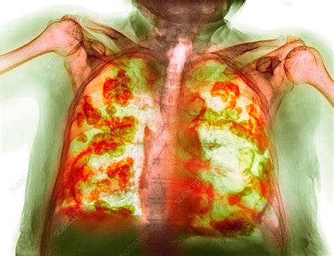 Bilateral Pleural Calcification X Ray Stock Image C0383923