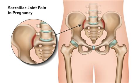 Sacroiliac During Pregnancy Symptoms Causes Symptoms Treatment Qi