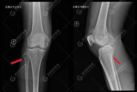 高尚病例：关注关节健康，了解各项检查特点 医院汇 丁香园