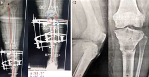 A Standing Scanogram After Correction Of The Limb Alignment At Four Download Scientific