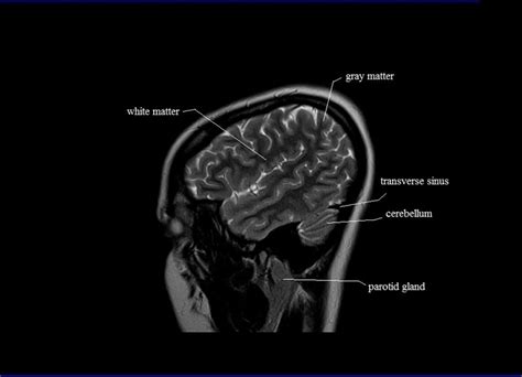 Cross Sectional Anatomy Mri Brain Sagittal Anatomy Free Mri Brain