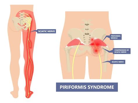 Piriformis Syndrome Symptoms Causes Diagnose Medicofit