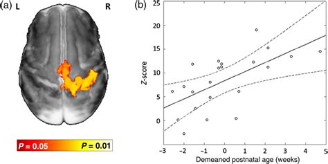 Interhemispheric Functional Connectivity During The Preterm Period Is Download Scientific
