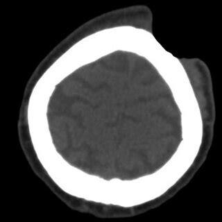 CT Scan Showing A Large Defect In The Scalp But Not Involving The Bone Download Scientific Diagram