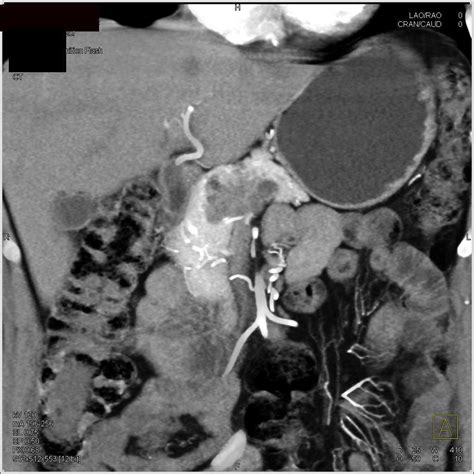 Serous Cystadenoma Pancreas Pancreas Radiology Case Studies Ctisus