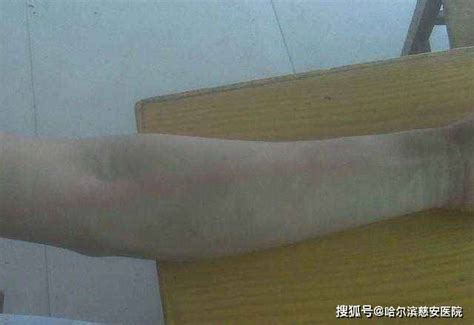 科普急性淋巴管炎 局部