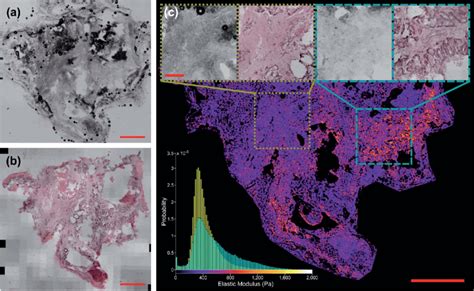 Liver Tissue Sample G340 03 02 Classified As Tumour A Shows