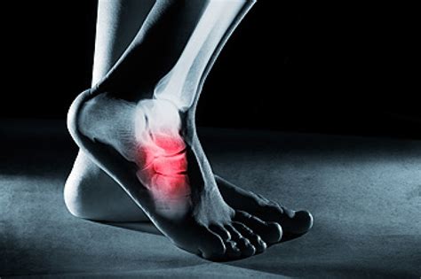 Definition And Causes Of Foot Stress Fractures