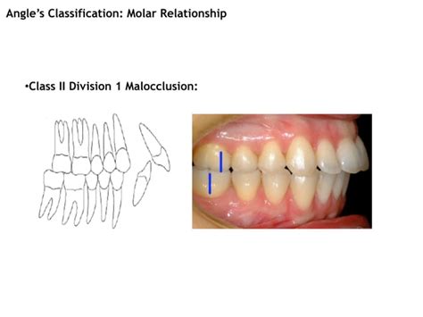 Maloccluison Ppt