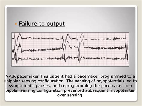 Follow Up And Management Of Pacemaker Programming And Pptx