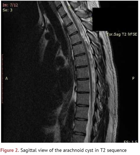 Thoracic Intradural Extramedullar Arachnoid Cyst In An Adult Case Report And Review Of The