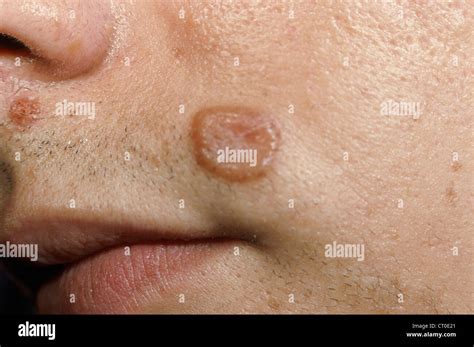 Cryptococcus Skin